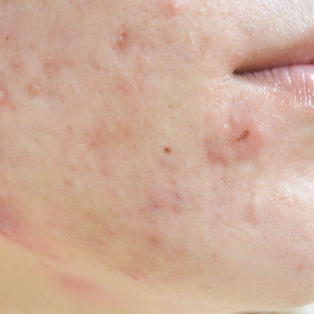 Your Guide to Treat Post Inflammatory Hyperpigmentation – GLO Skin Body